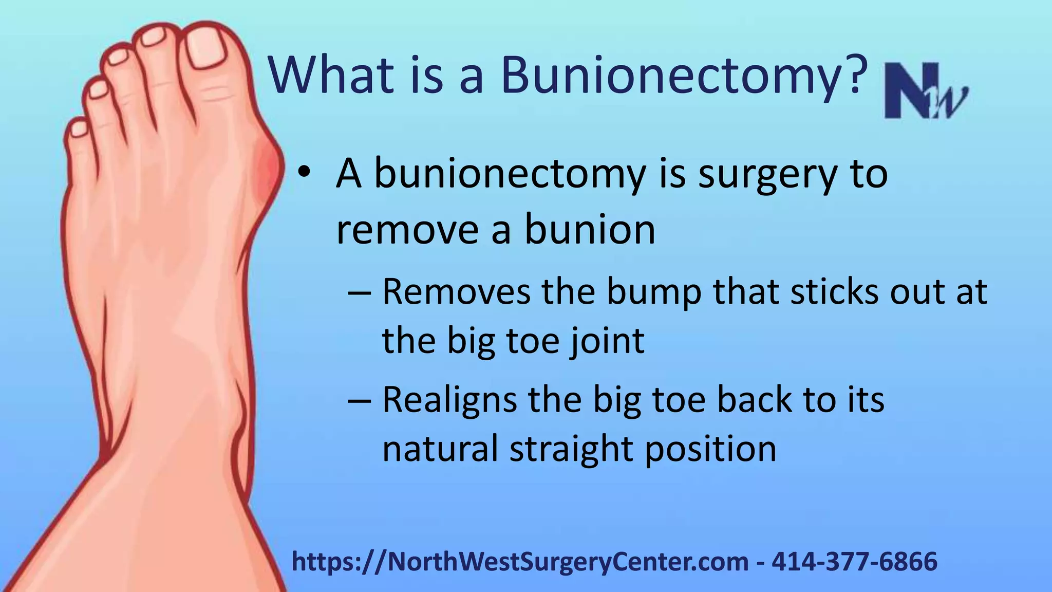 What Is A Bunionectomy? | PPTX