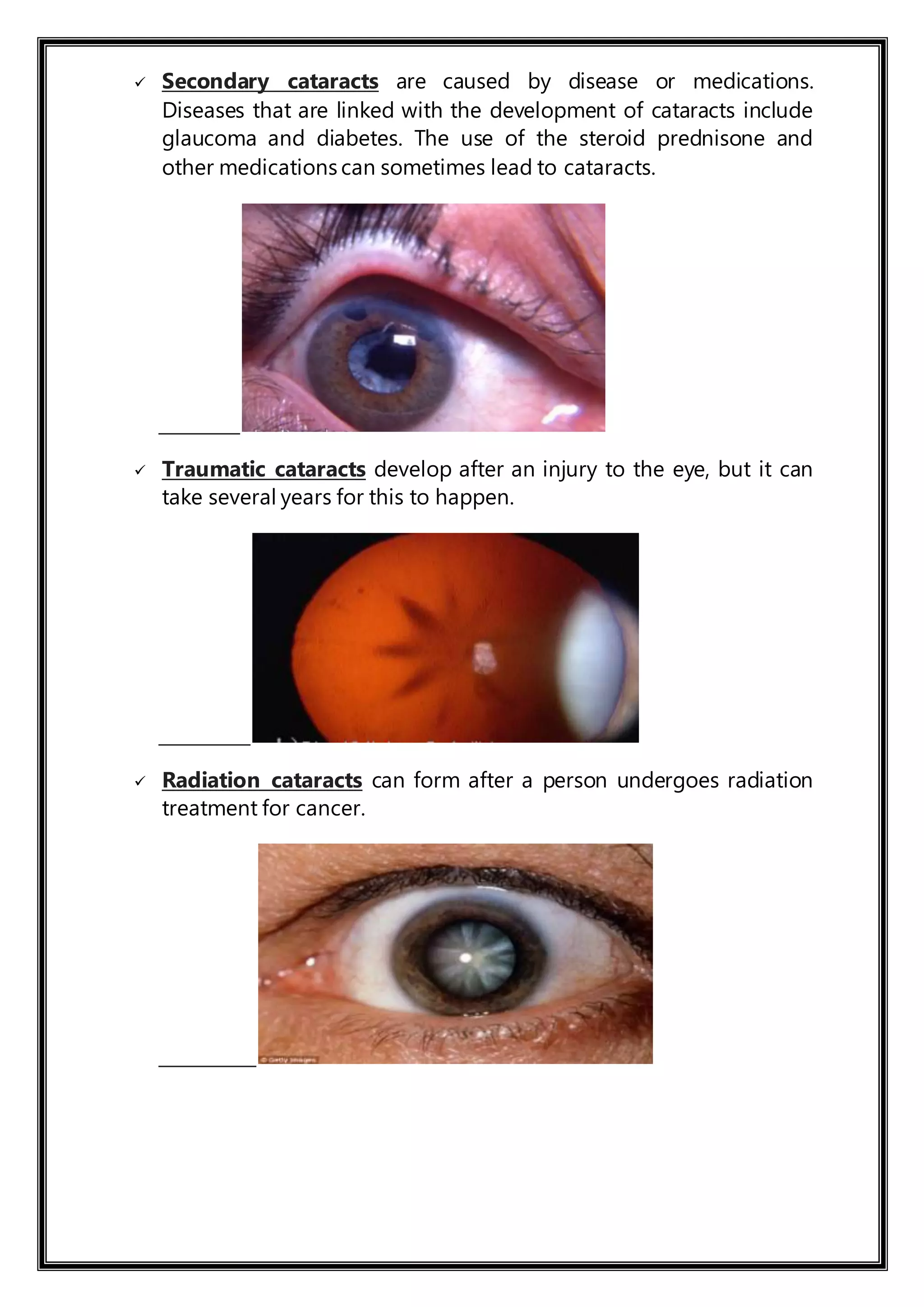 Cataract | DOCX