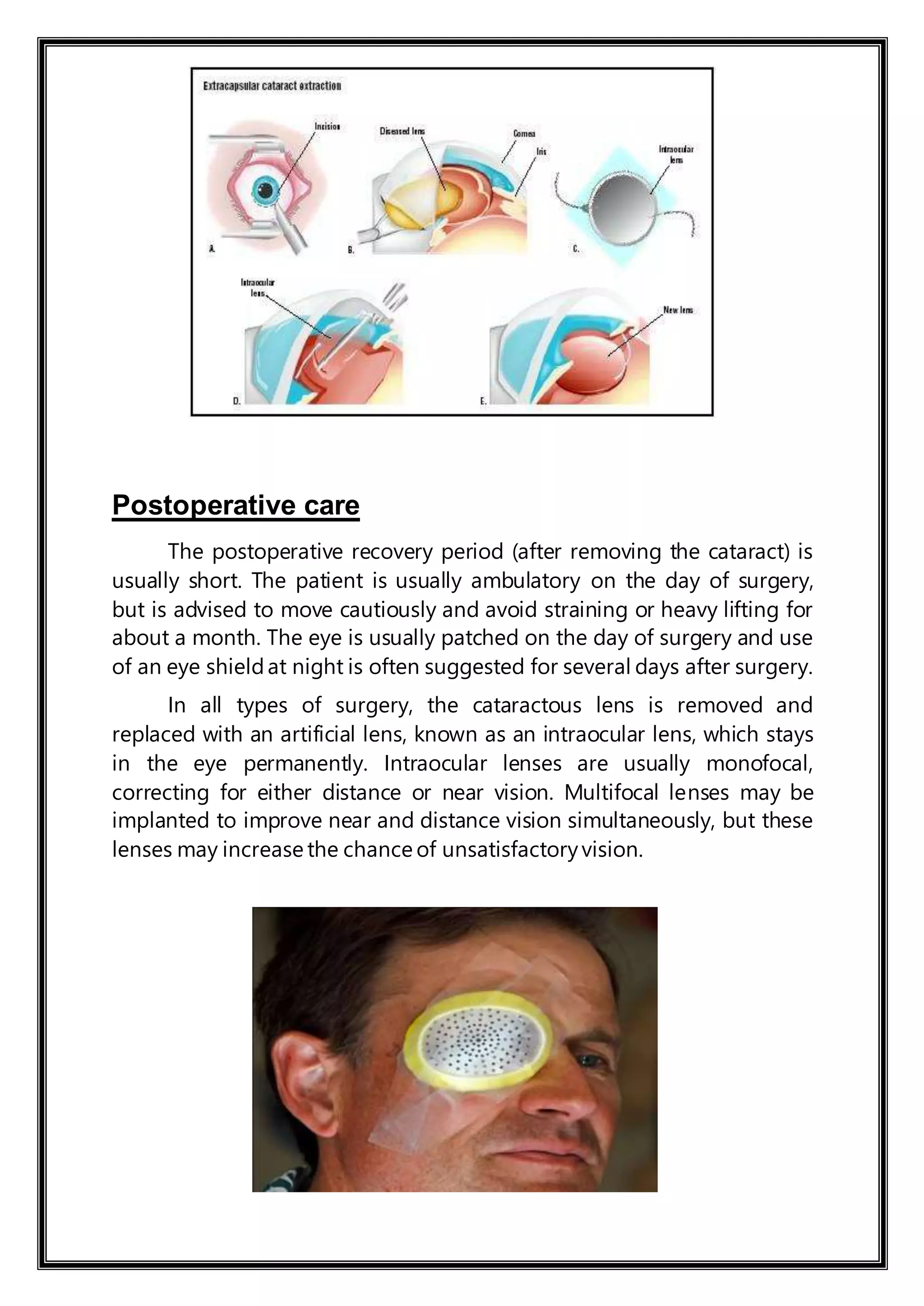 Cataract | DOCX
