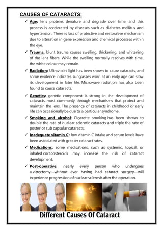 Cataract | DOCX