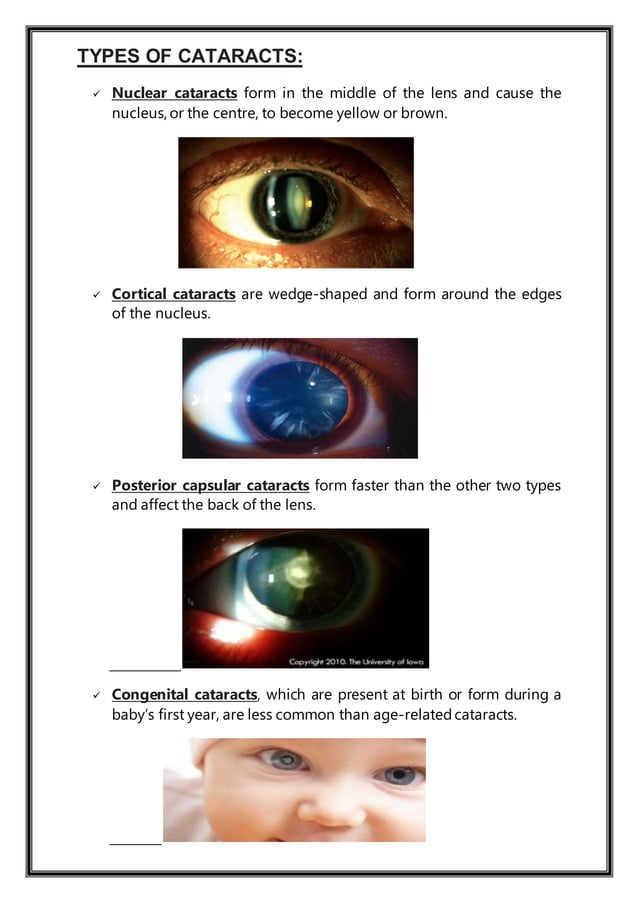 Cataract | DOCX | Eye and Vision Conditions | Diseases and Conditions