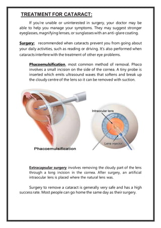 Cataract | DOCX