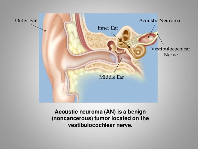 What is acoustic neuroma?