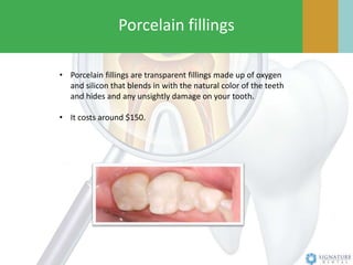What is a Dental Filling by Signature Dental | PPT