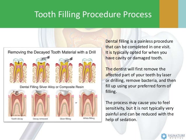 What is a Dental Filling by Signature Dental