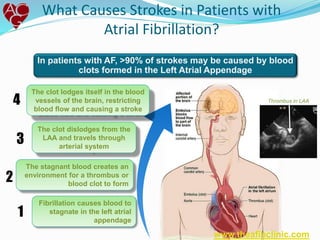 What is Atrial Fibrillation (afib)? | PPTX