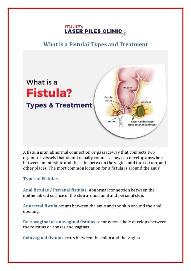 What is a Fistula? Types and Treatment | Fistula Treatment