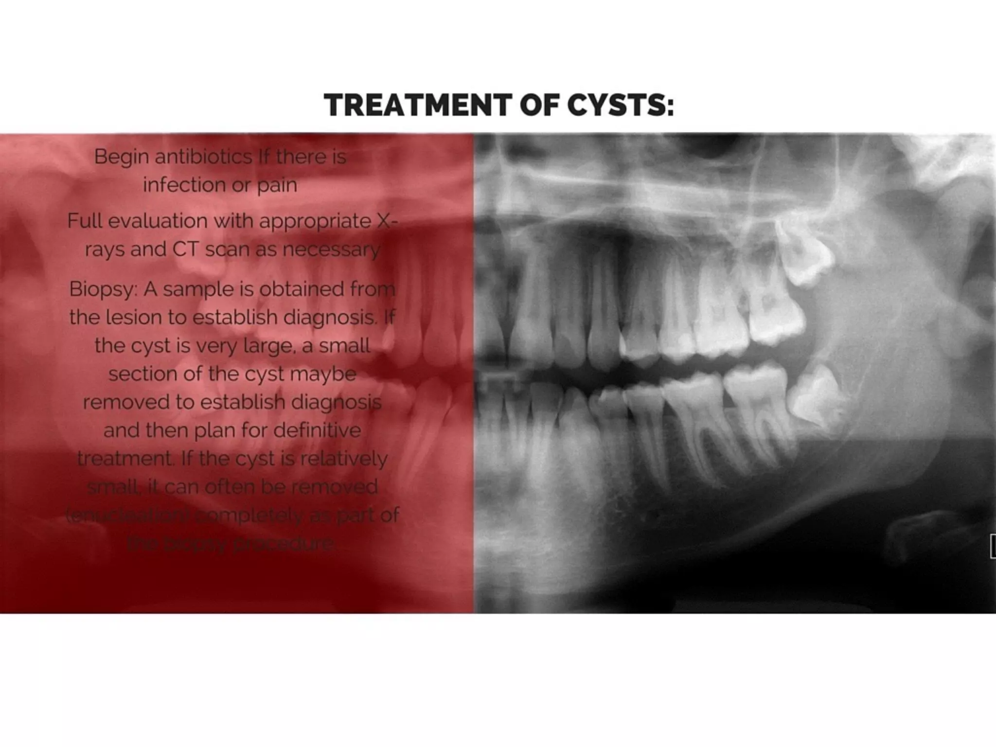 What is a Jaw Bone Cyst? | PDF