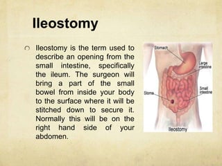 What is an Ostomy | PPSX
