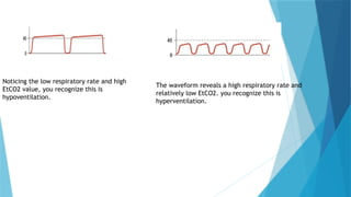 What is Capnography anesthesia point of view | PPTX