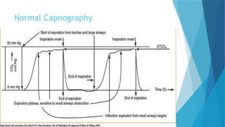 What is Capnography anesthesia point of view | PPTX