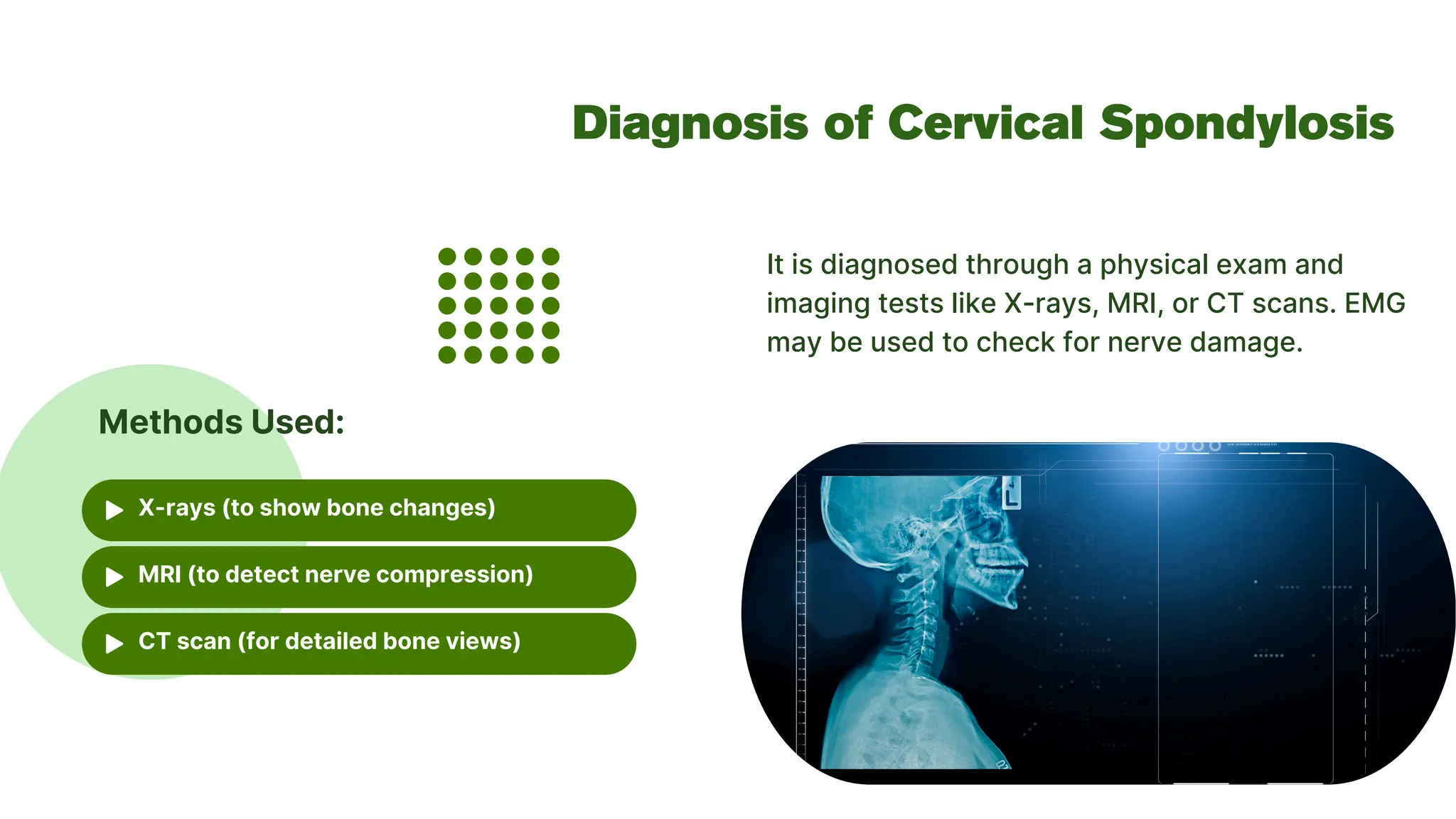 What is Cervical Spondylosis? Complete Guide & Overview | PDF