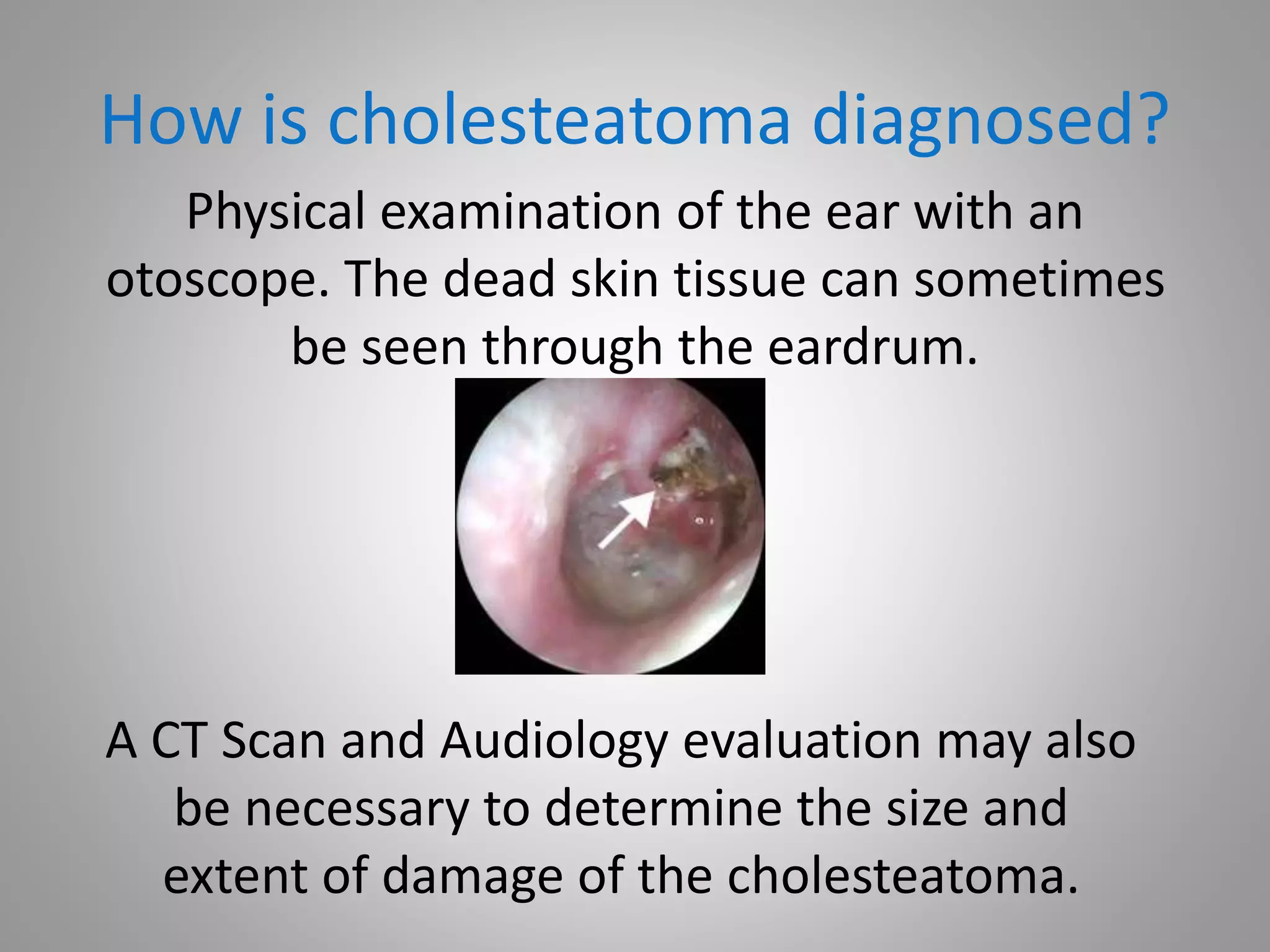 What is Cholesteatoma? | PPTX