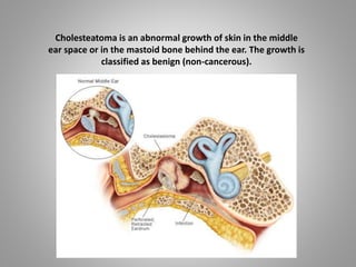 What is Cholesteatoma? | PPTX