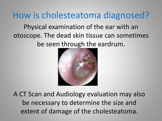What is Cholesteatoma? | PPTX | Ear, Nose and Throat Conditions ...