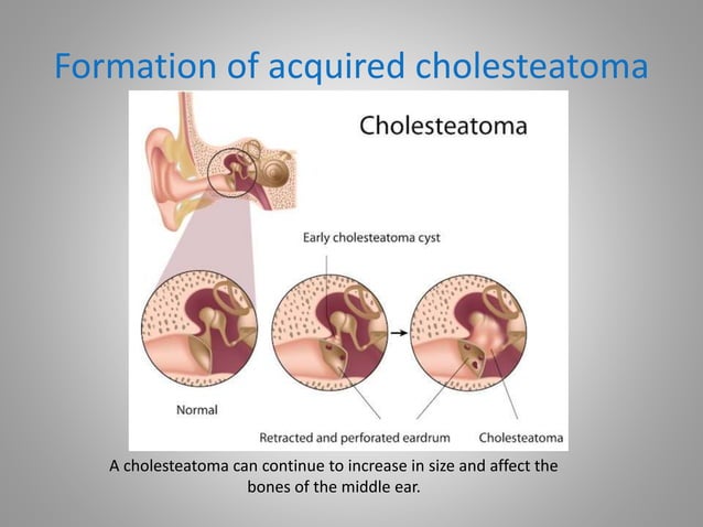 What is Cholesteatoma?