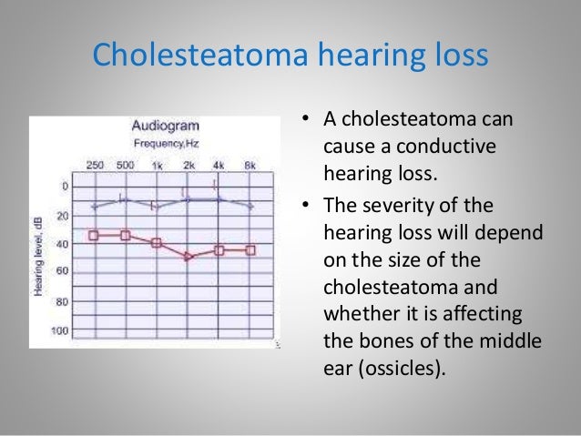 What is Cholesteatoma?