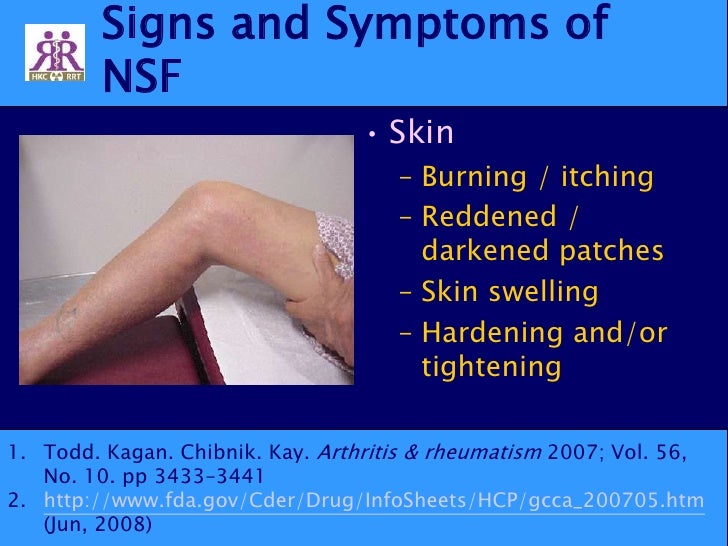 Nephrogenic Systemic Fibrosis Treatment