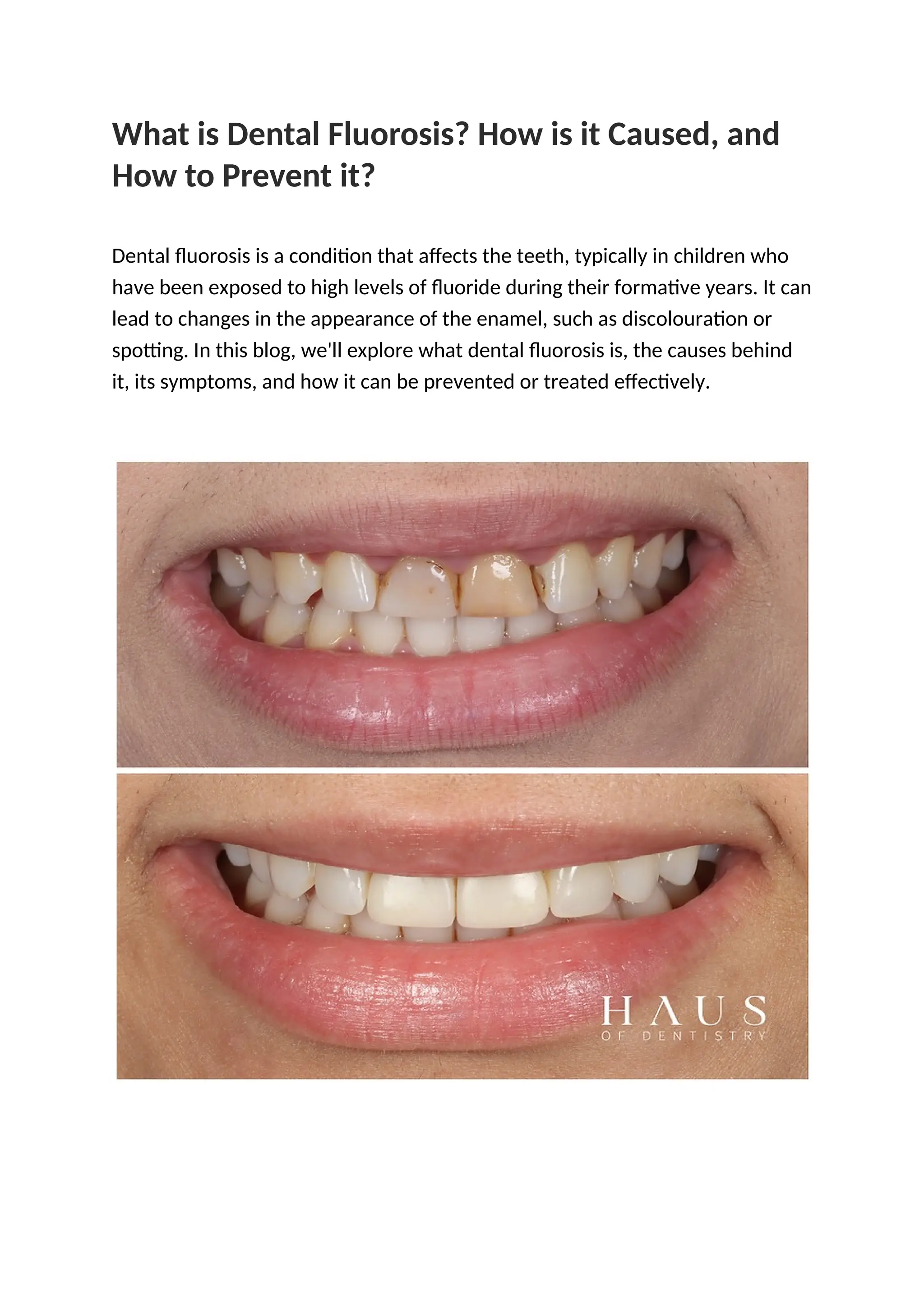 What is Dental Fluorosis? How is it Caused, and How to Prevent it? | DOCX