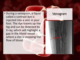 What is DVT? | PPTX | Blood Disorders | Diseases and Conditions