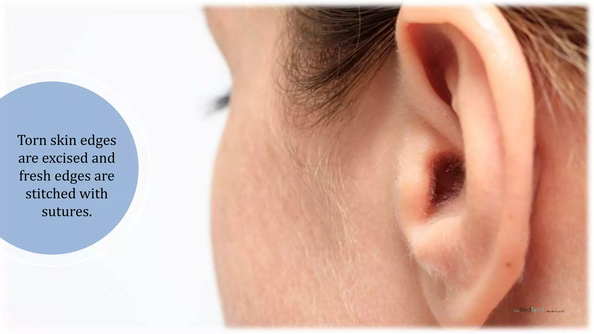 What is Earlobe Repair and How it can be Useful | PPTX