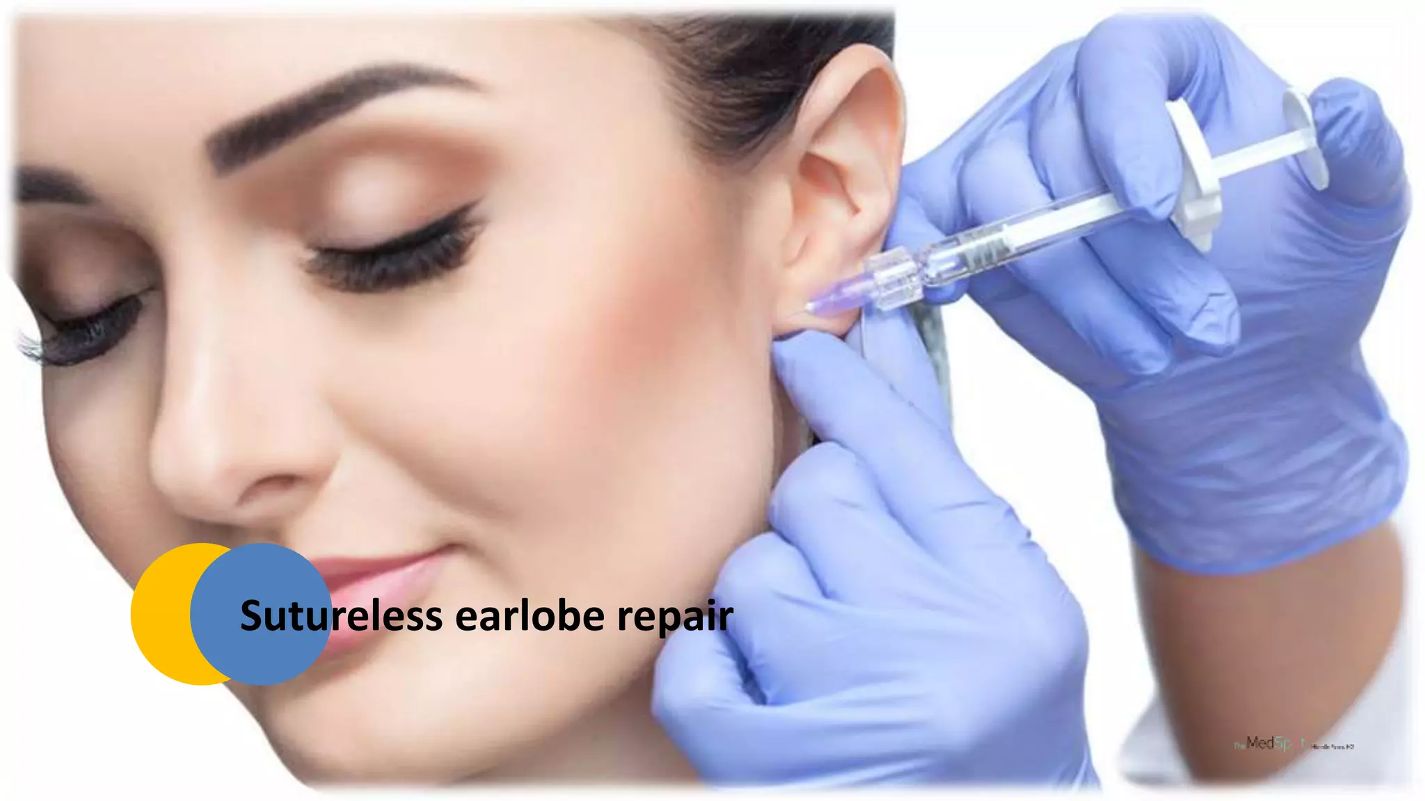 What is Earlobe Repair and How it can be Useful | PPTX