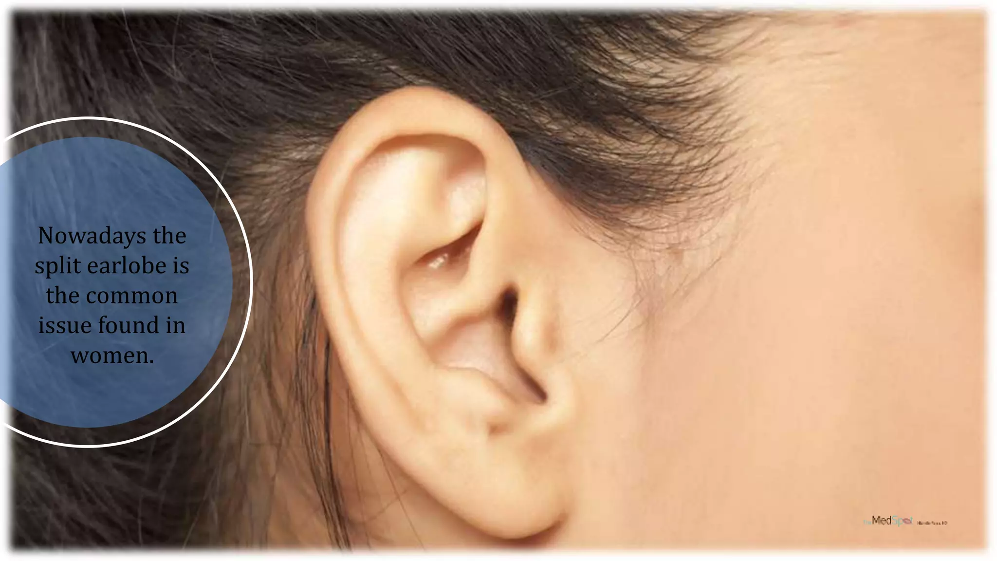 What is Earlobe Repair and How it can be Useful | PPTX