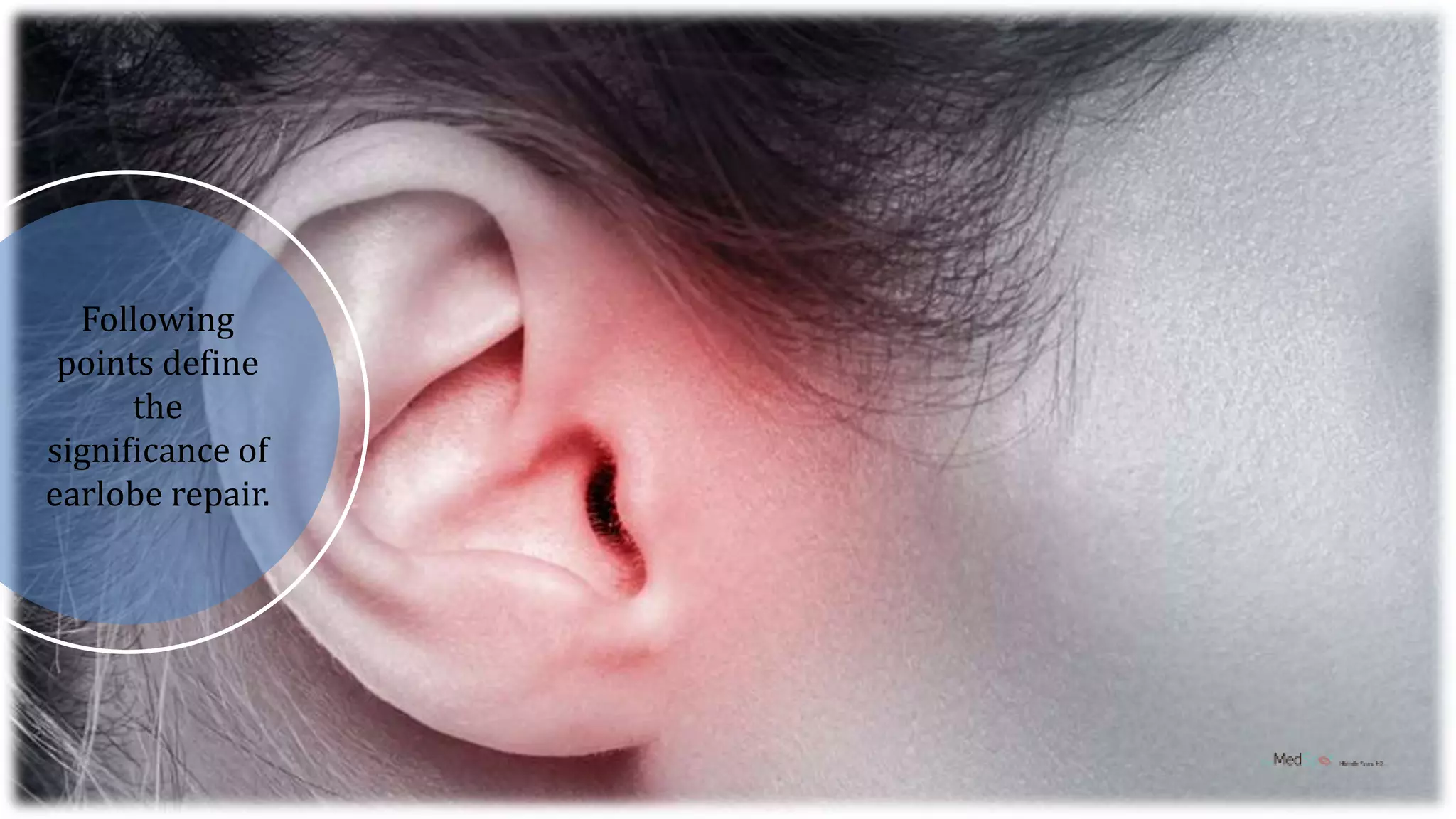 What is Earlobe Repair and How it can be Useful | PPTX