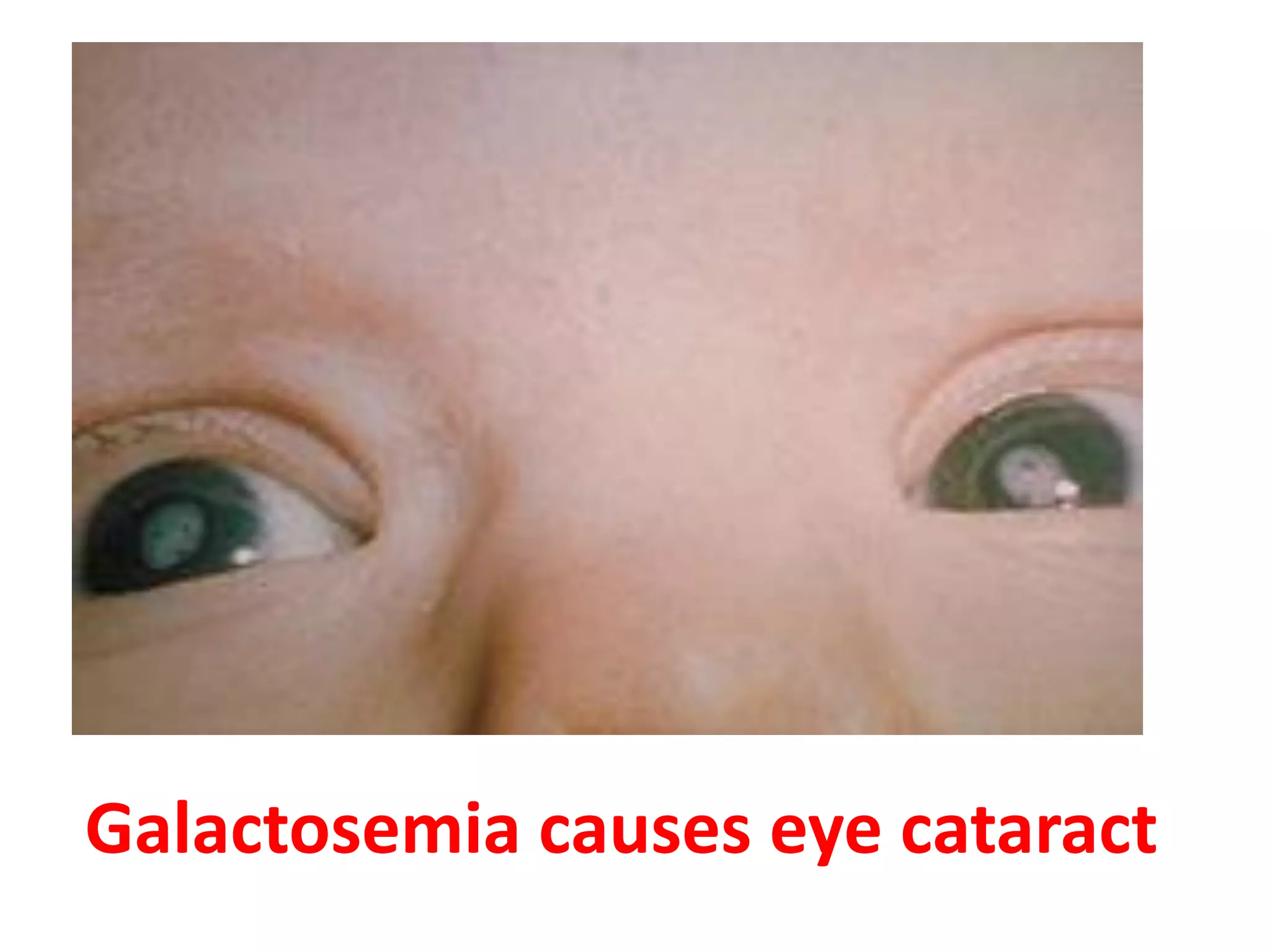 What is galactosemia | PDF