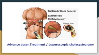 What is Gallbladder Stone , Causes and Treatment.pptx