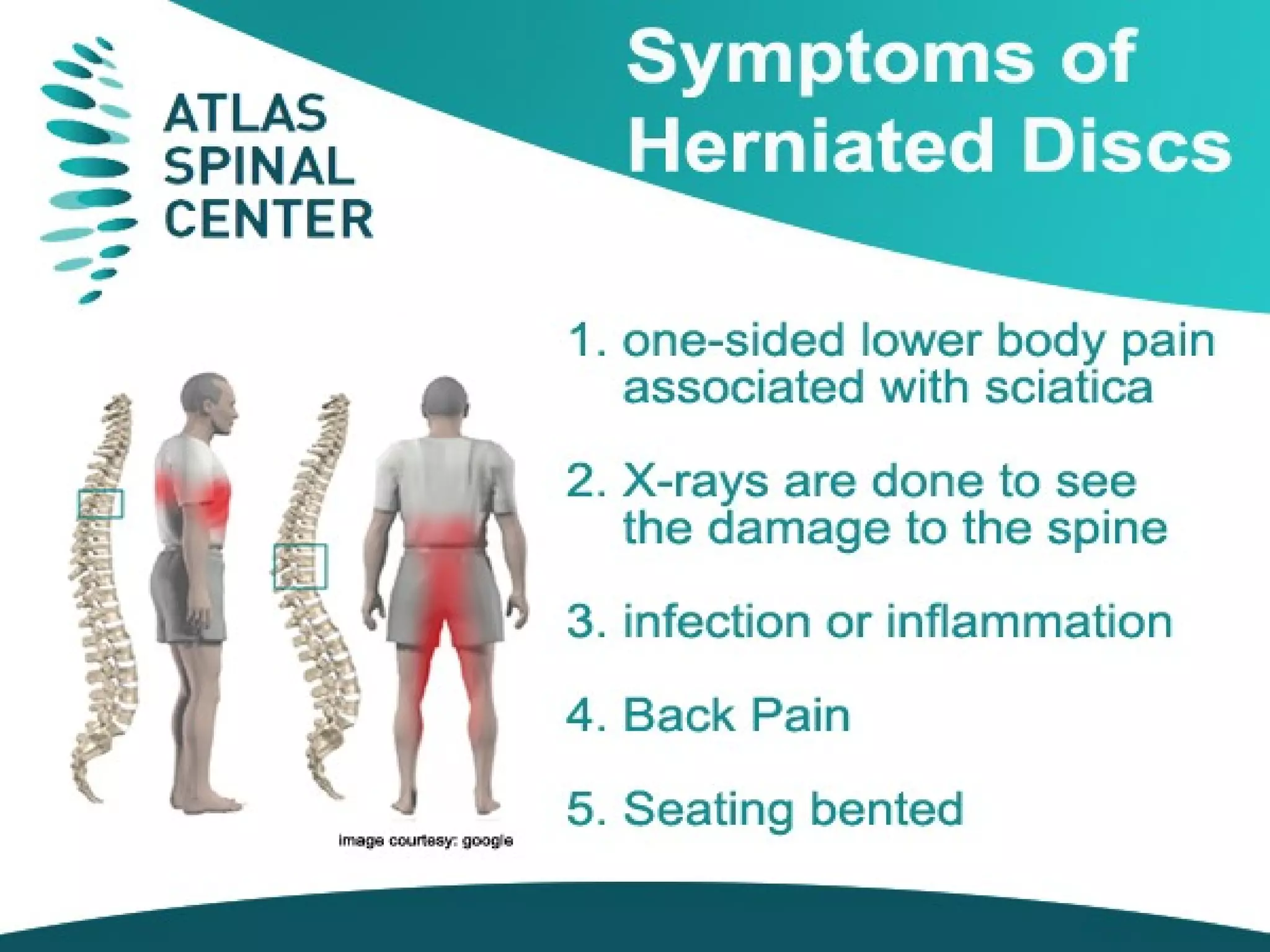 What is herniated disc | PPT