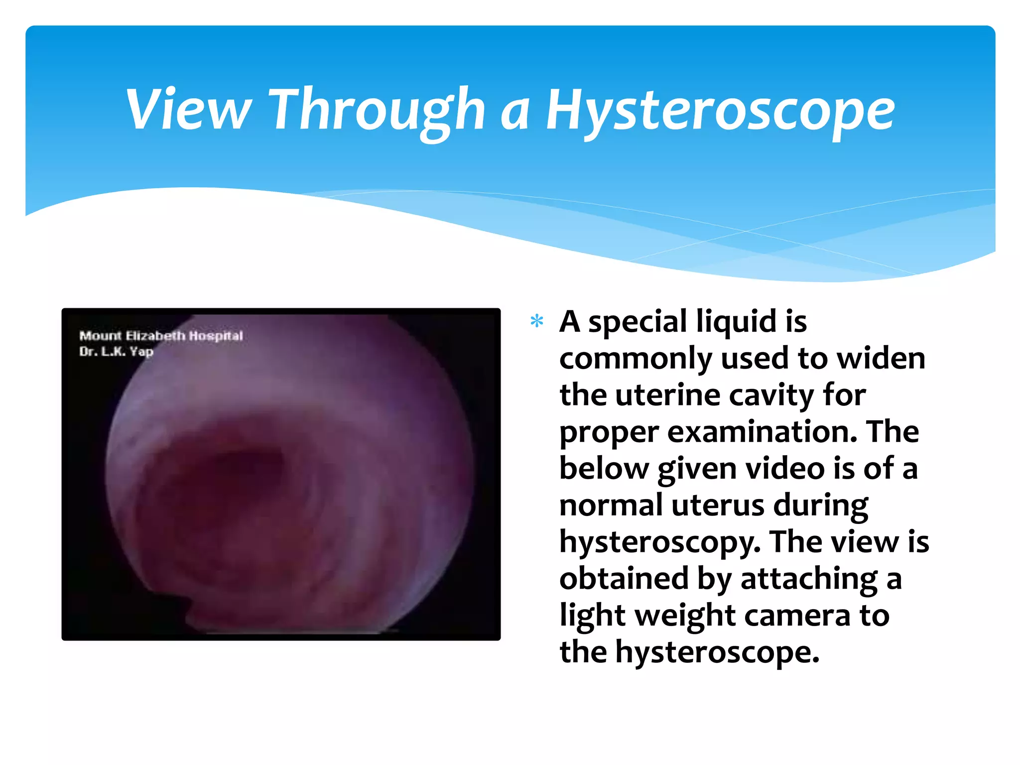 What is Hysteroscopy? | PPTX