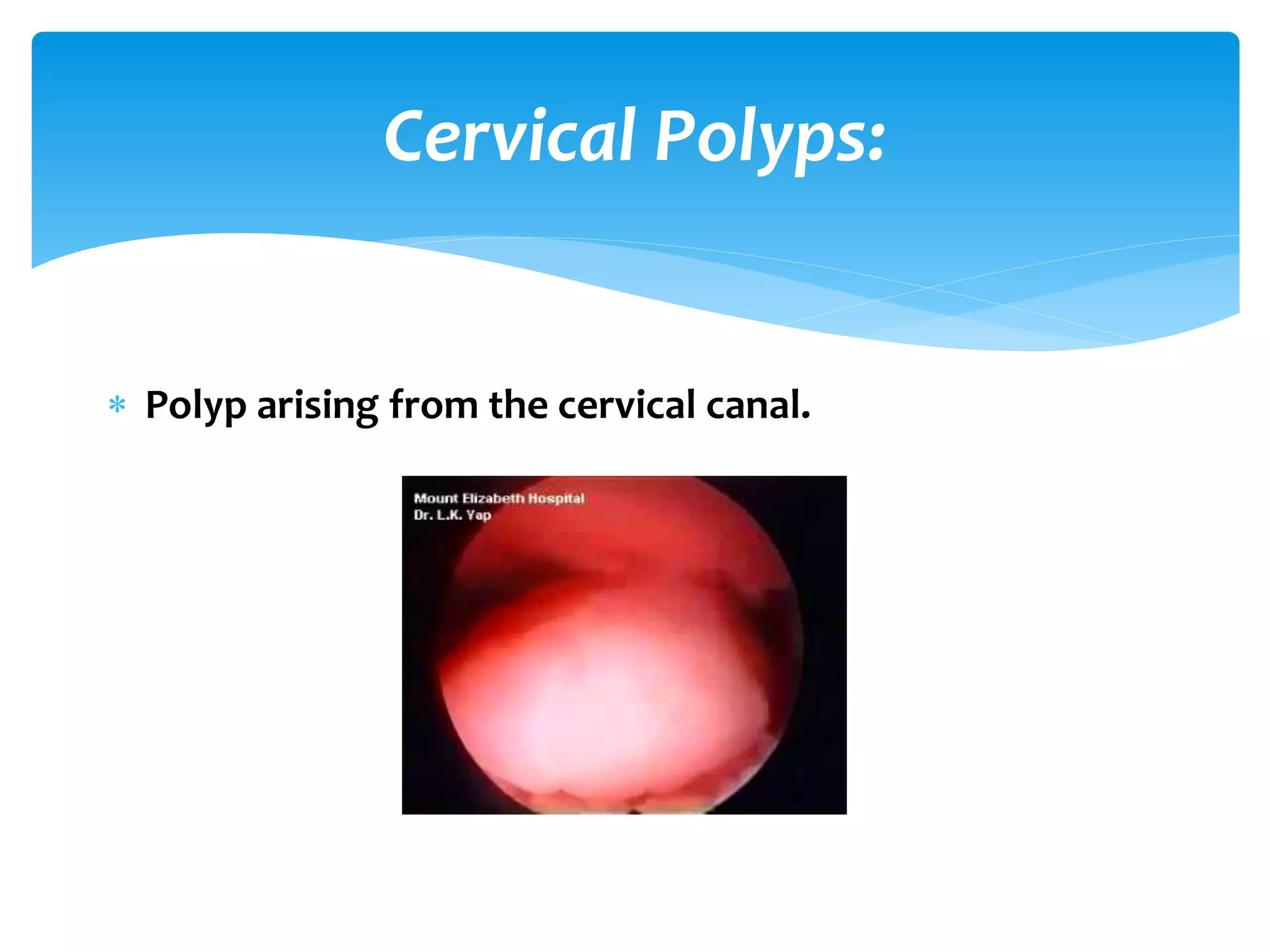 What is Hysteroscopy? | PPTX