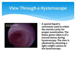 What is Hysteroscopy? | PPTX