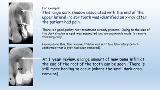 What is involved in endodontic surgery? | PPT