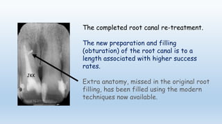 What is involved in root canal re treatment | PDF