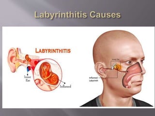 What is labyrinthitis | PPTX