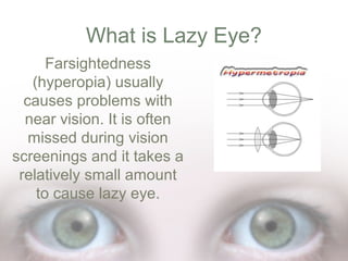 What is lazy eye? | PPT