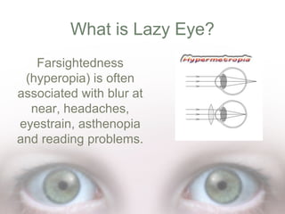 What is lazy eye? | PPT