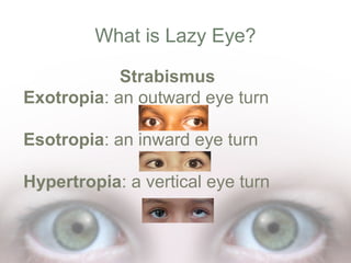 What is lazy eye? | PPT
