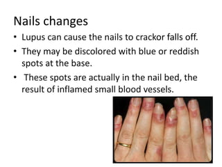 What is lupus | PPTX | Lung and Respiratory Health | Diseases and ...