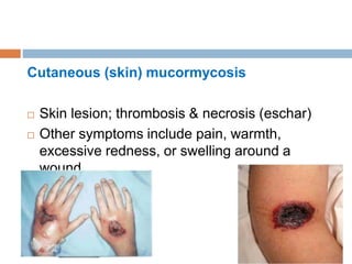 Mucormycosis | PPT