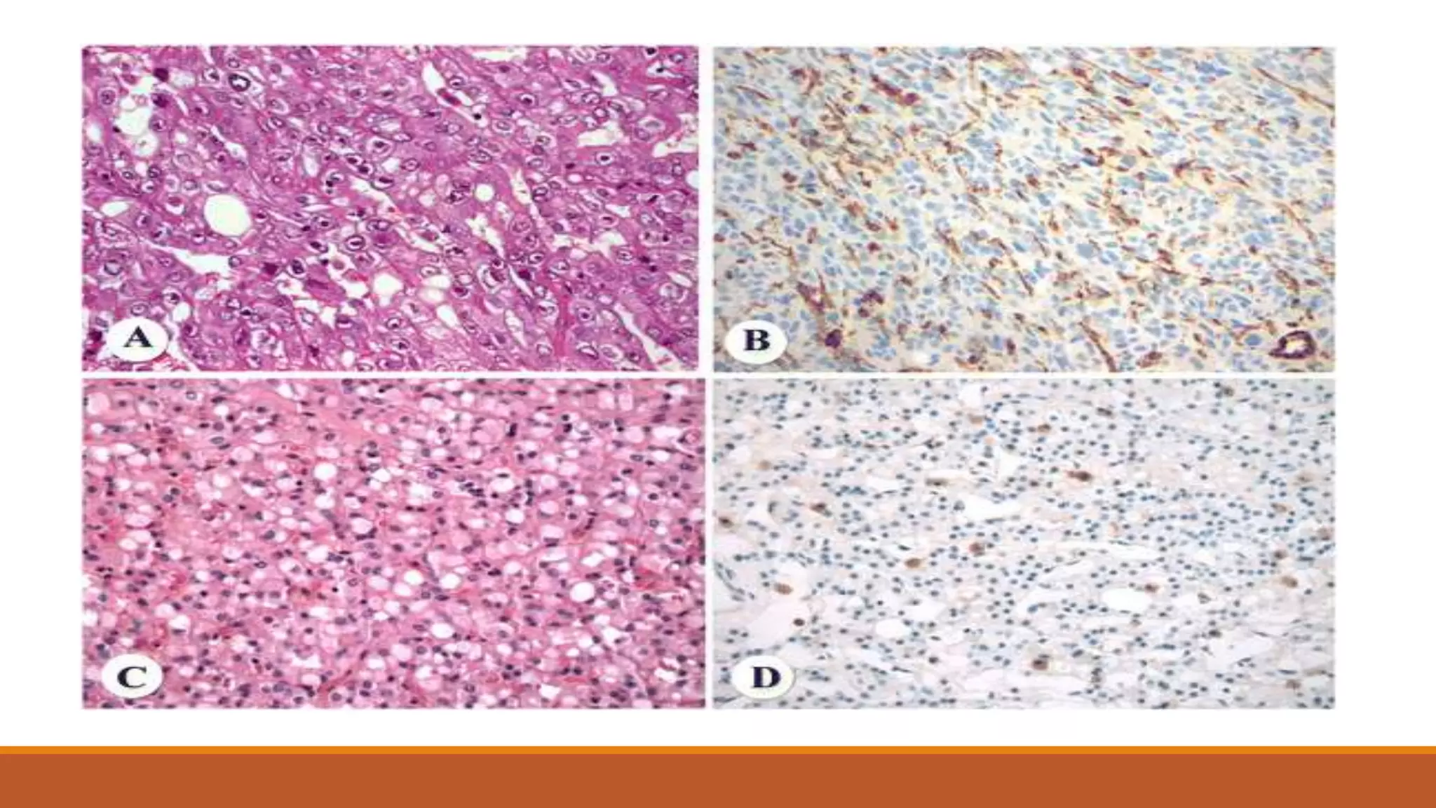 What is new in Genitourinary pathology | PPTX