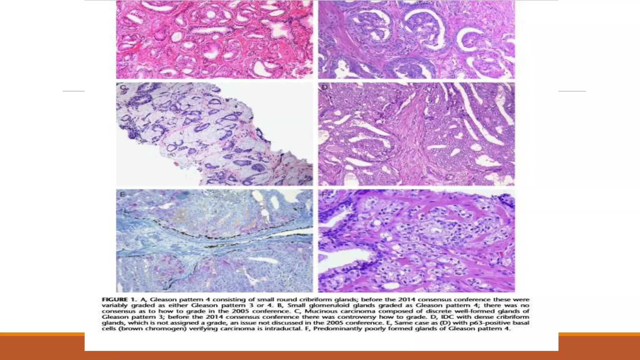 What is new in Genitourinary pathology | PPTX