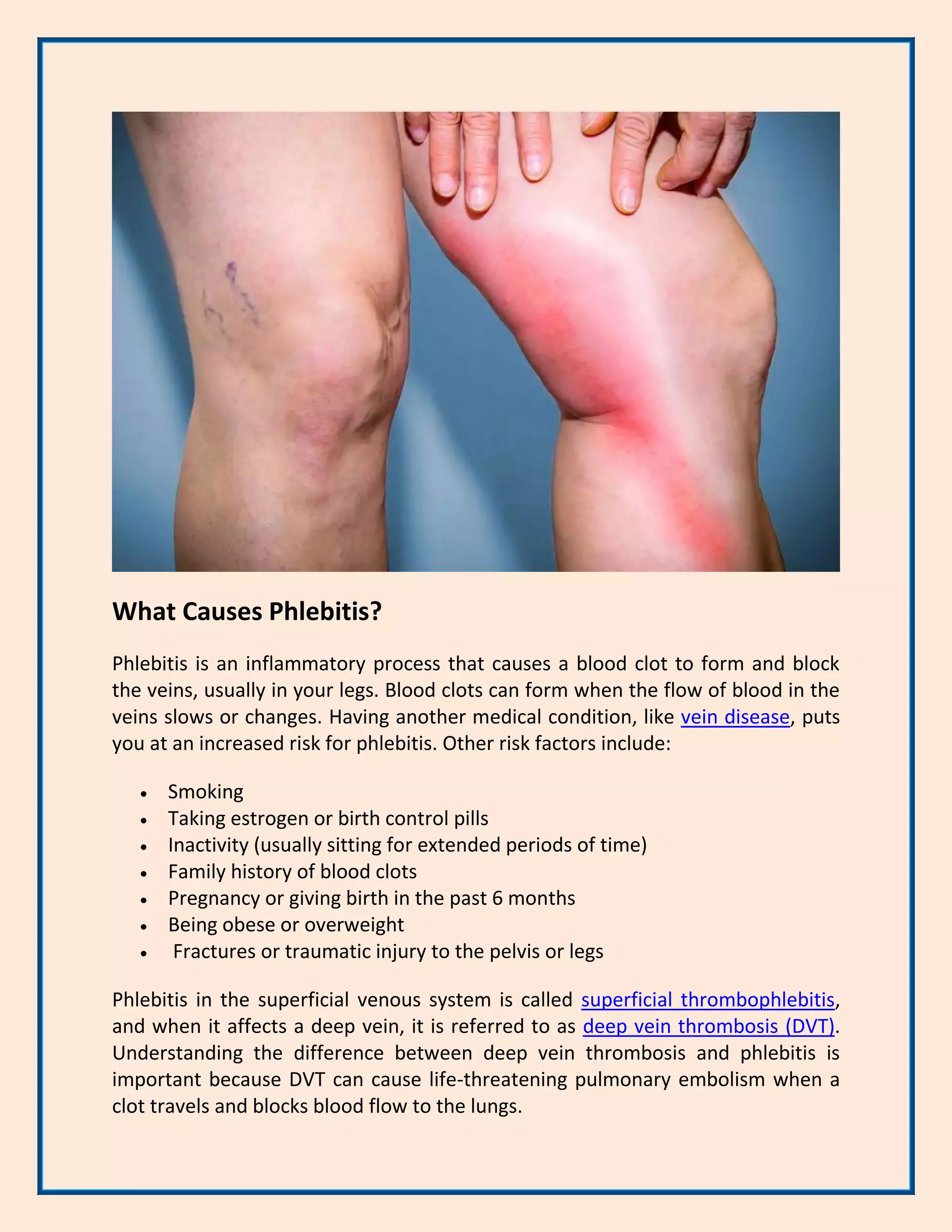 What is Phlebitis and How is it Treated? | PDF