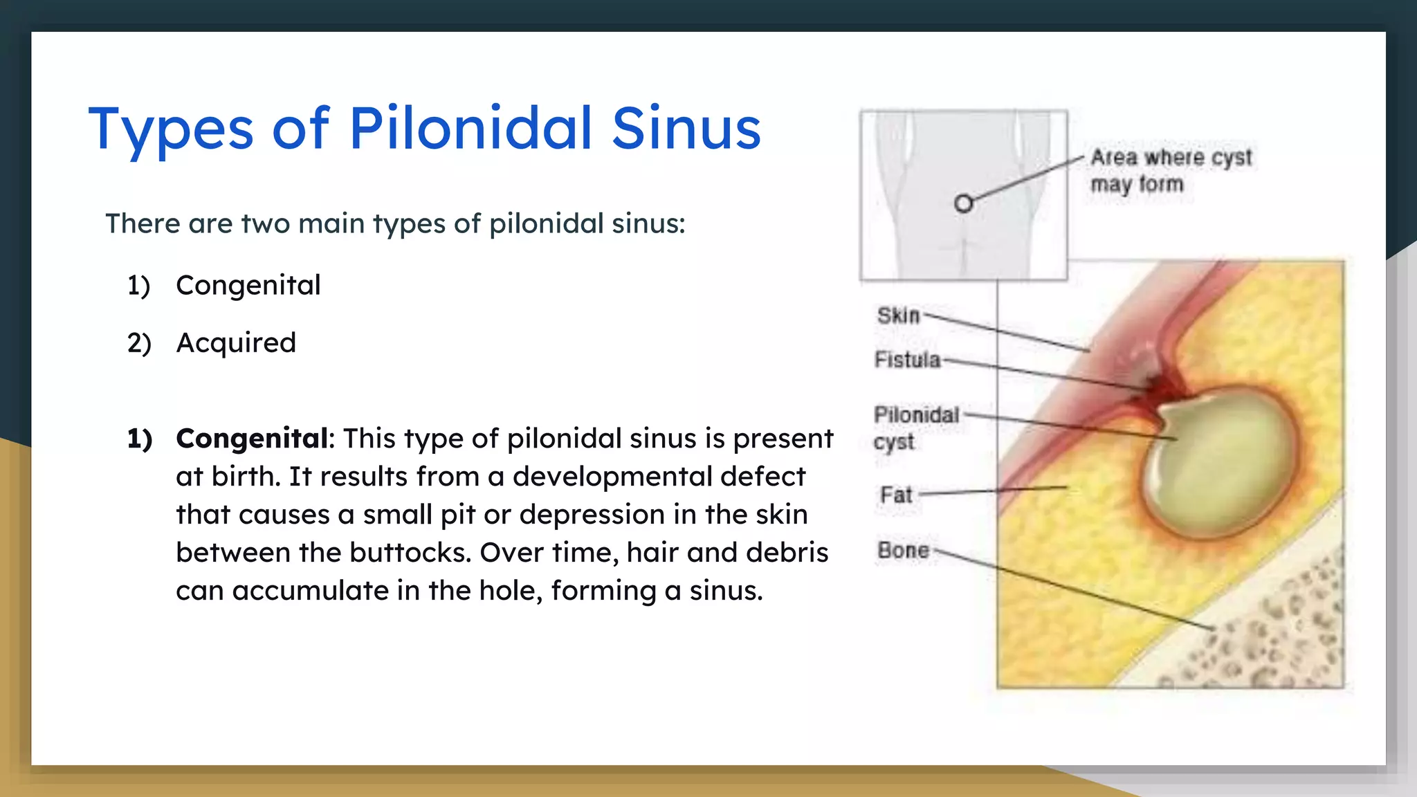 What Is Pilonidal Sinus Causes Symptoms And Treatment pptx What Is Pilonidal Sinus Causes Symptoms And Treatment pptx