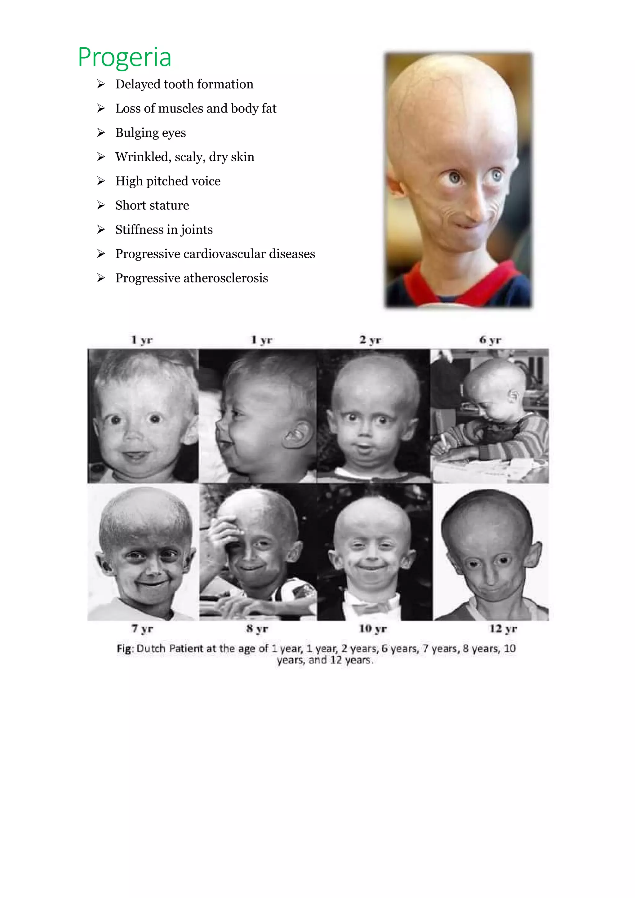 Progeria | PDF | Heart and Cardiovascular Diseases | Diseases and ...
