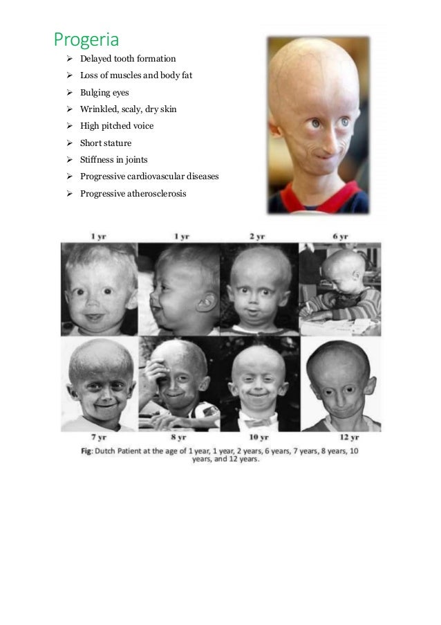 Progeria
