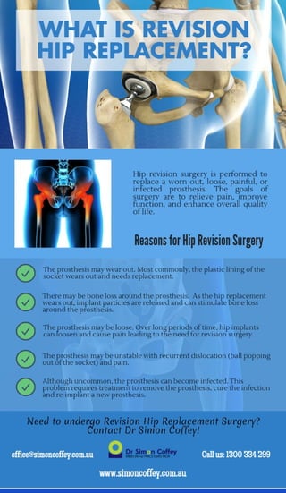 What Is Revision Hip Replacement? | PDF