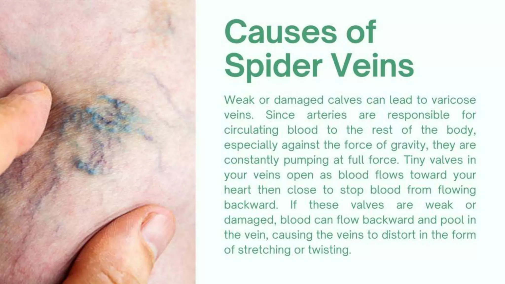 What is spider vein treatment? ppt | PPT